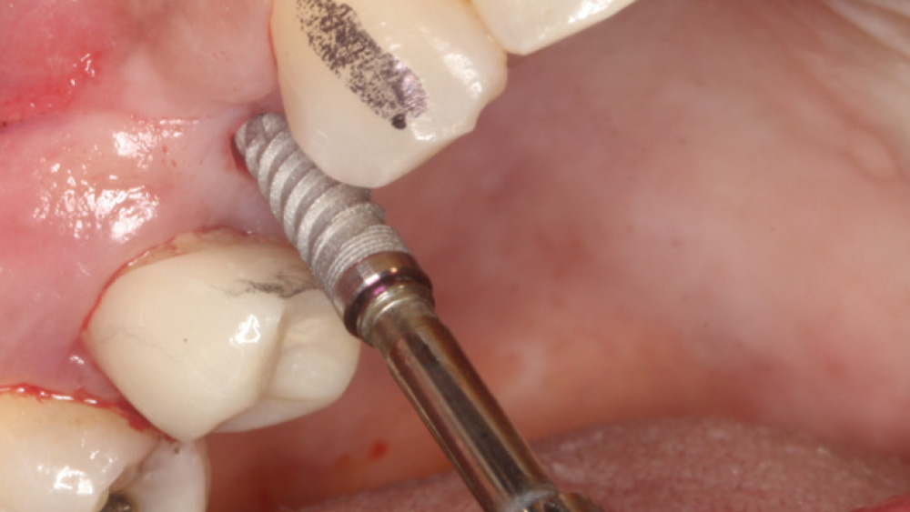 Flapless Dental Implant. When to Use a Flapless Technique?