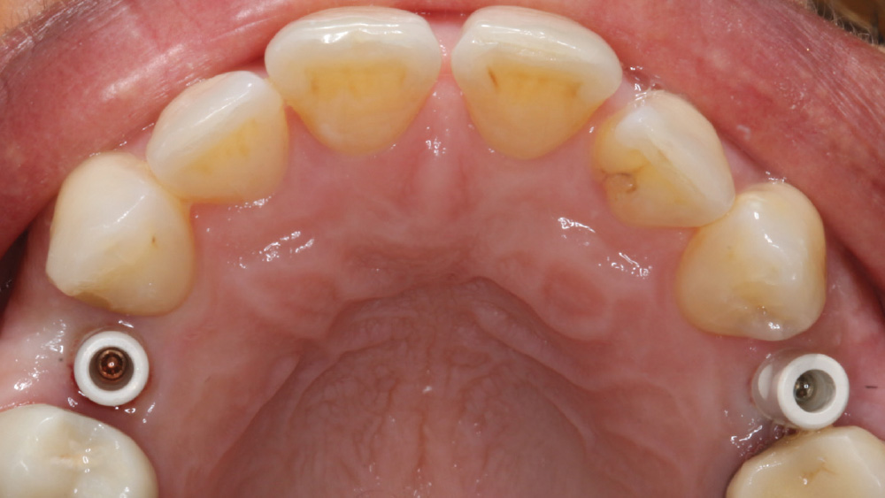 Flapless Dental Implant. When to Use a Flapless Technique?