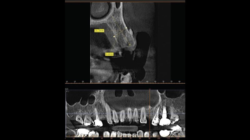 Flapless Dental Implant. When to Use a Flapless Technique?