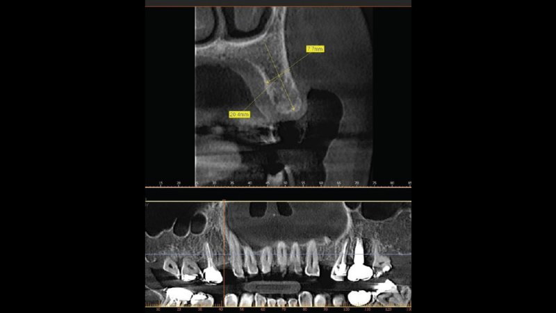 Flapless Dental Implant. When to Use a Flapless Technique?