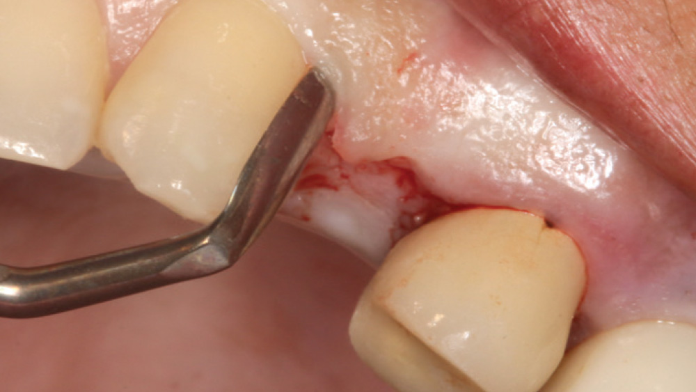 Flapless Dental Implant. When to Use a Flapless Technique?