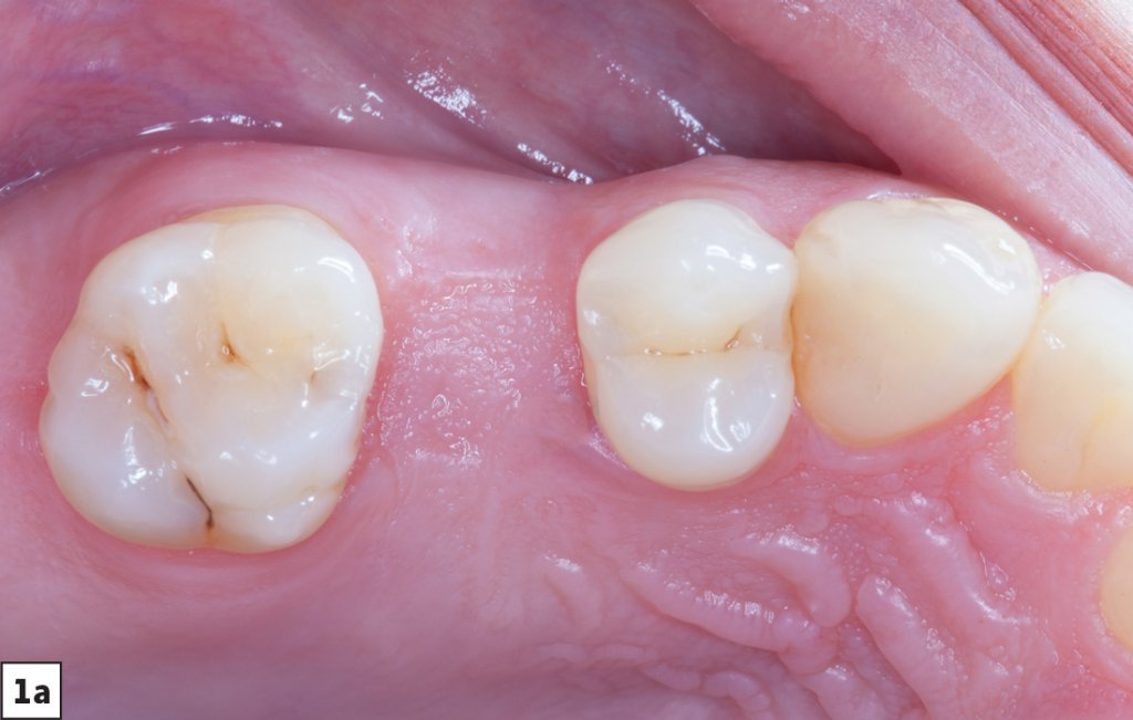 Immediate Implant Provisionalization: Four Ways | Glidewell