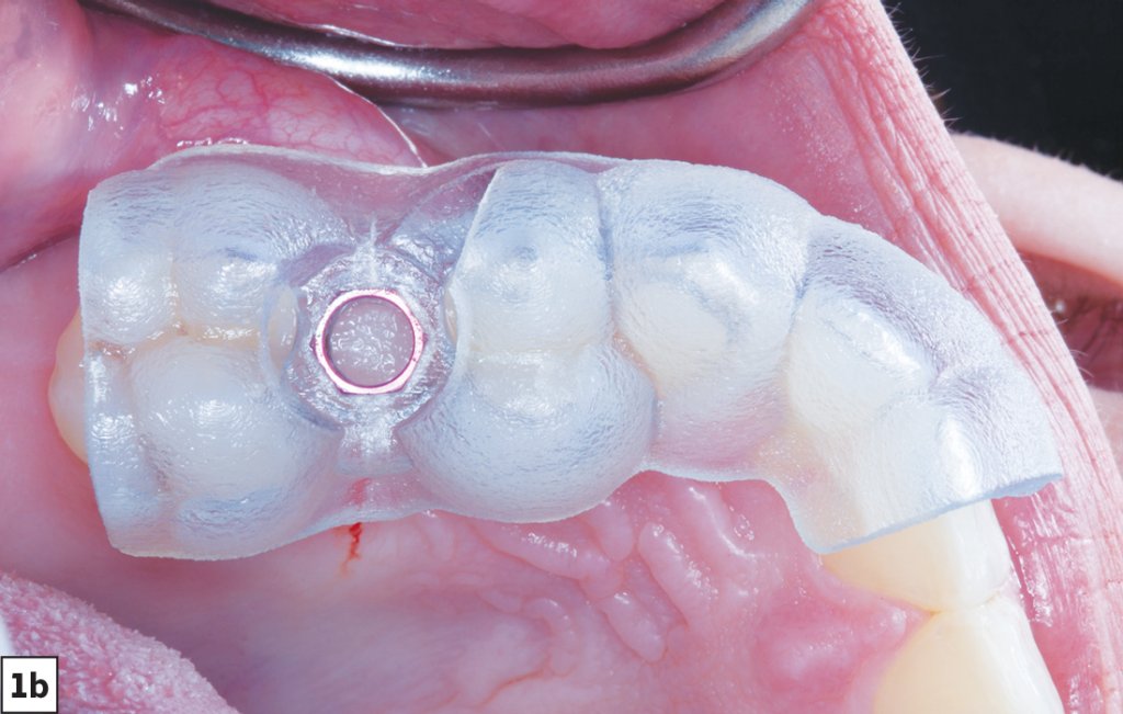 Immediate Implant Provisionalization: Four Ways | Glidewell