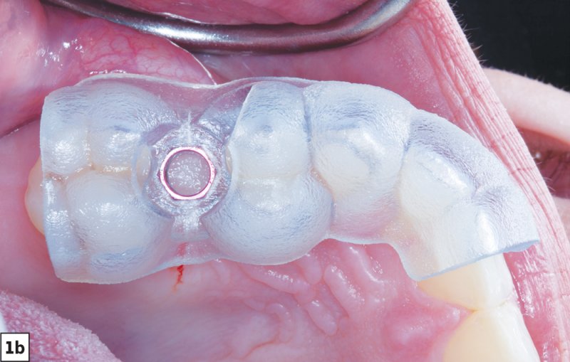Immediate Implant Provisionalization: Four Ways | Glidewell