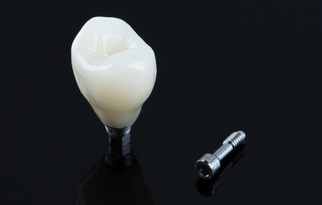 Immediate Implant Provisionalization: Four Ways | Glidewell