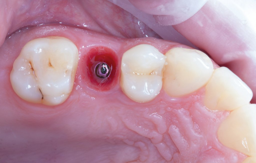Immediate Implant Provisionalization: Four Ways | Glidewell