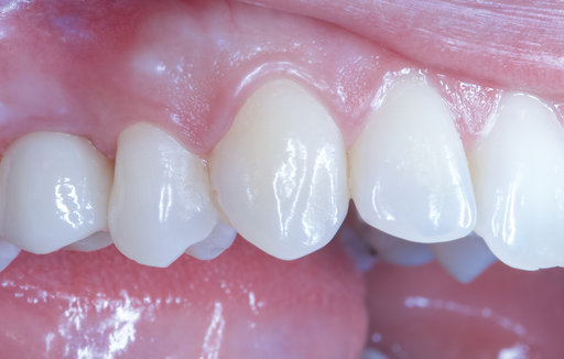 Immediate Implant Provisionalization: Four Ways | Glidewell
