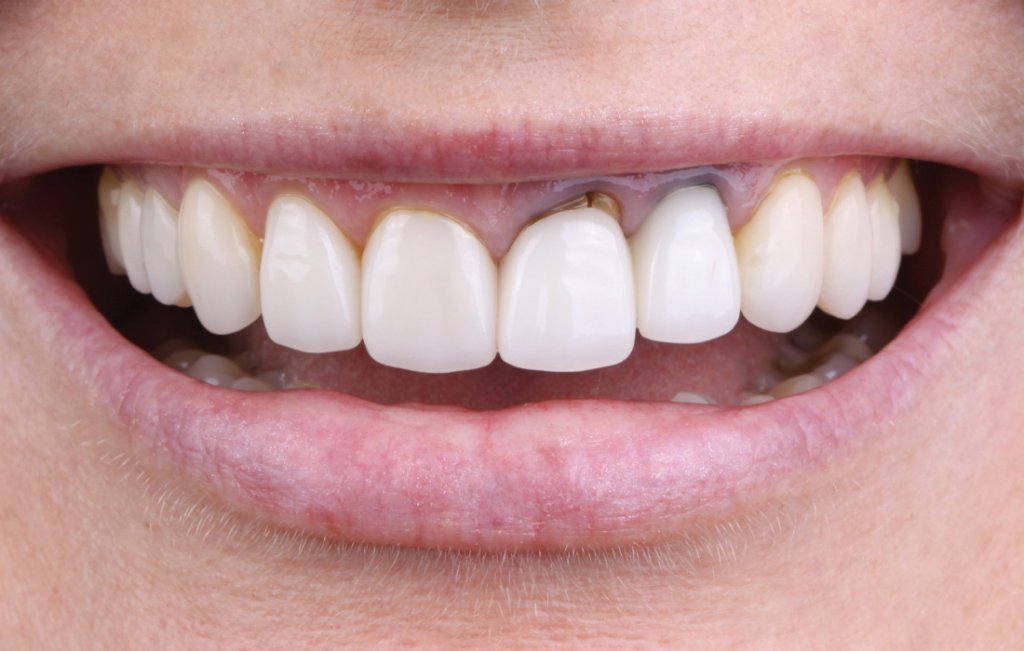 Immediate Implant Provisionalization: Four Ways | Glidewell