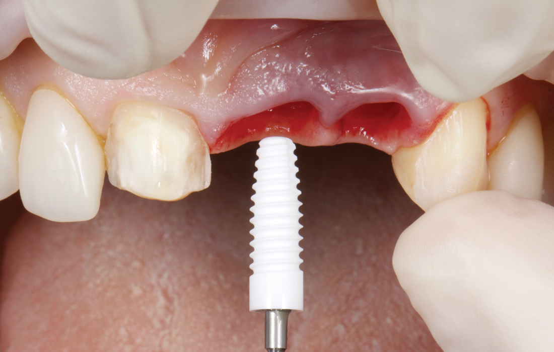 Immediate Implant Provisionalization: Four Ways | Glidewell