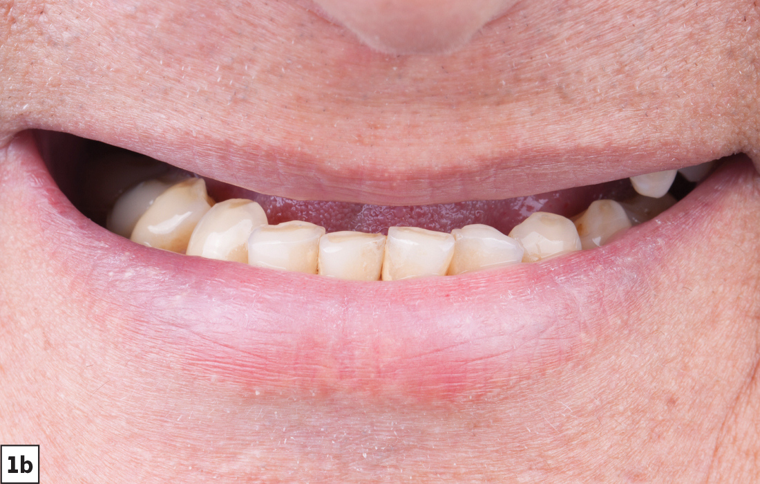 Immediate Implant Provisionalization: Four Ways | Glidewell