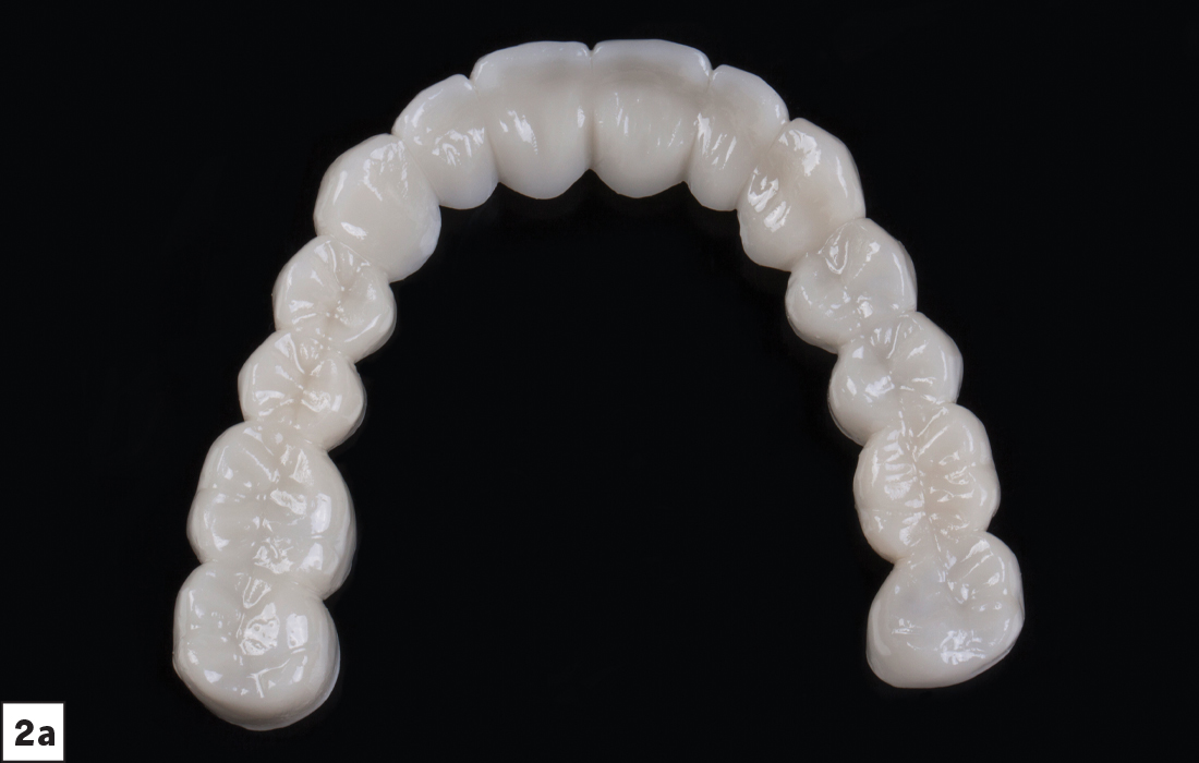 Immediate Implant Provisionalization: Four Ways | Glidewell