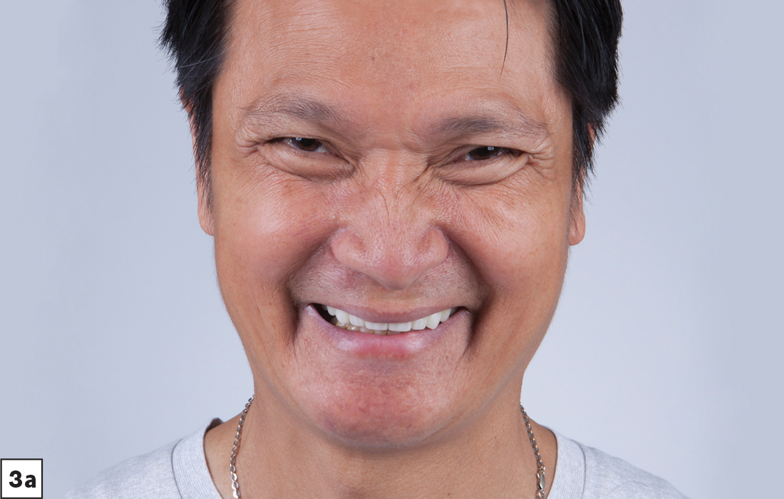 Immediate Implant Provisionalization: Four Ways | Glidewell