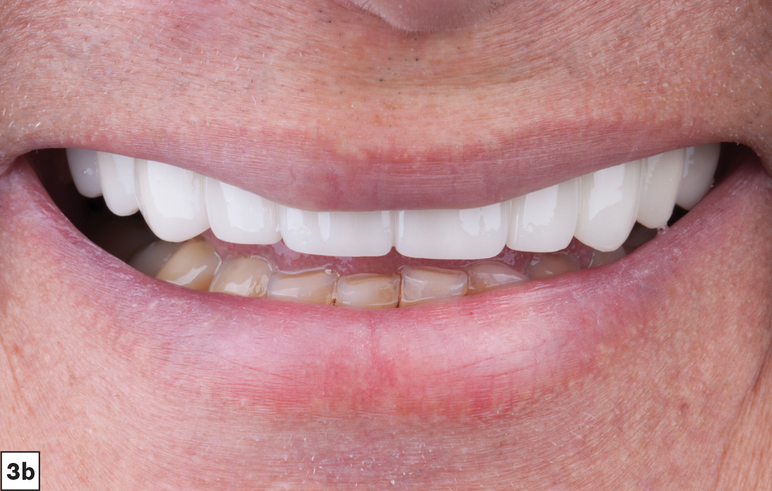 Immediate Implant Provisionalization: Four Ways | Glidewell