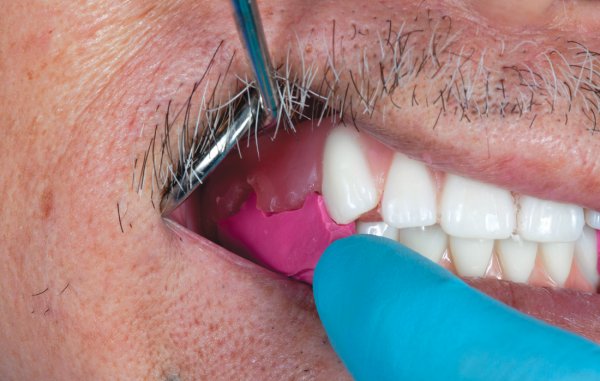 BruxZir Full Arch Implant Prosthesis: Simplified Clinical Protocol ...