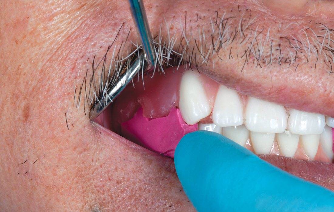 BruxZir Full Arch Implant Prosthesis: Simplified Clinical Protocol ...