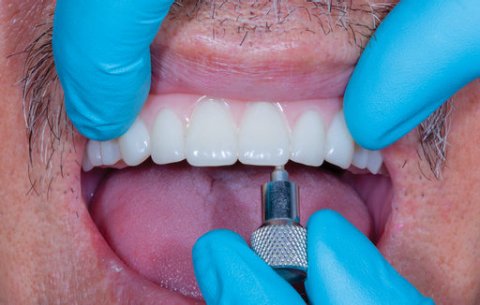 BruxZir Full Arch Implant Prosthesis: Simplified Clinical Protocol ...