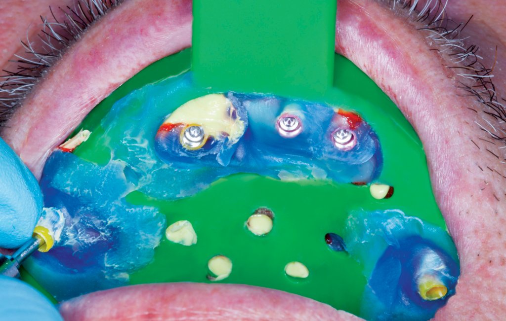 BruxZir Full Arch Implant Prosthesis: Simplified Clinical Protocol ...