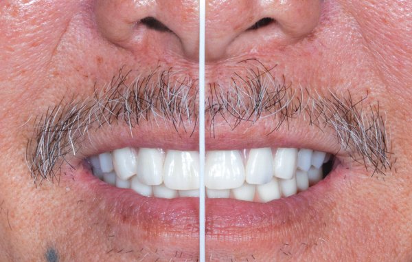 BruxZir Full Arch Implant Prosthesis: Simplified Clinical Protocol ...