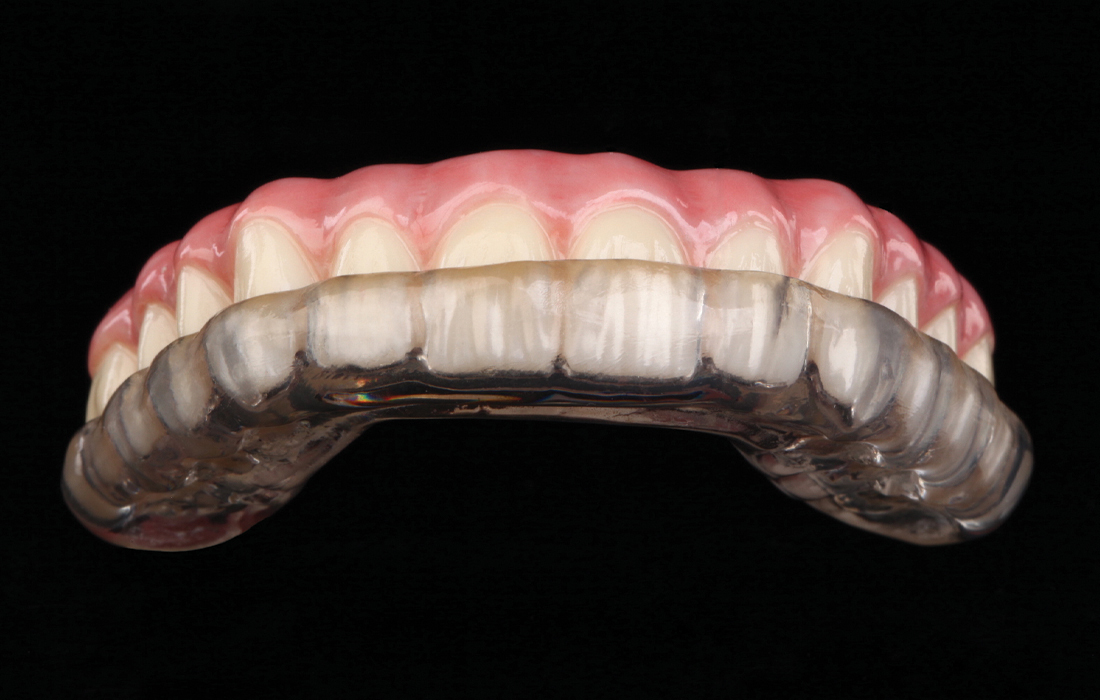 BruxZir Full Arch Implant Prosthesis: Simplified Clinical Protocol ...