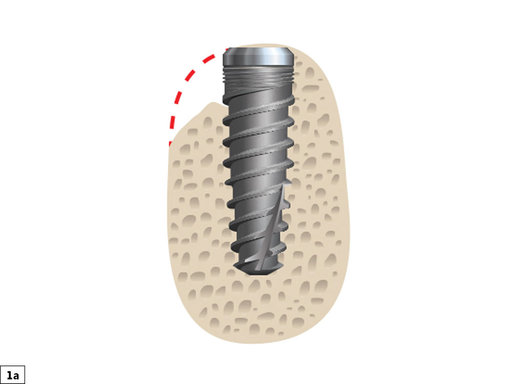 Guided Bone Regeneration: 8 Augmentation Steps | Glidewell