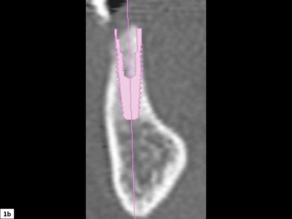 Guided Bone Regeneration: 8 Augmentation Steps | Glidewell