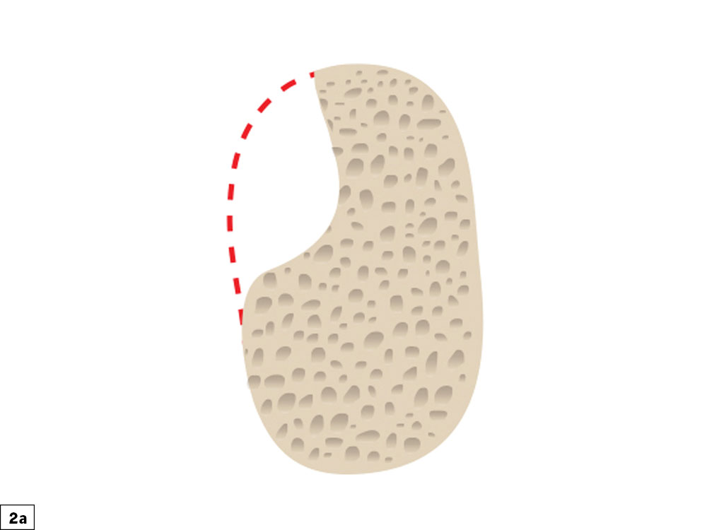 Guided Bone Regeneration: 8 Augmentation Steps | Glidewell