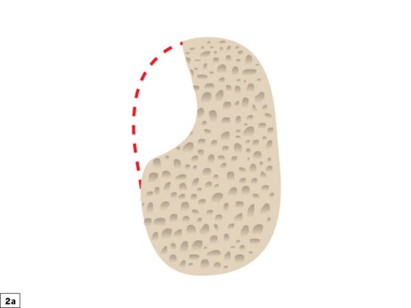 Guided Bone Regeneration: 8 Augmentation Steps | Glidewell