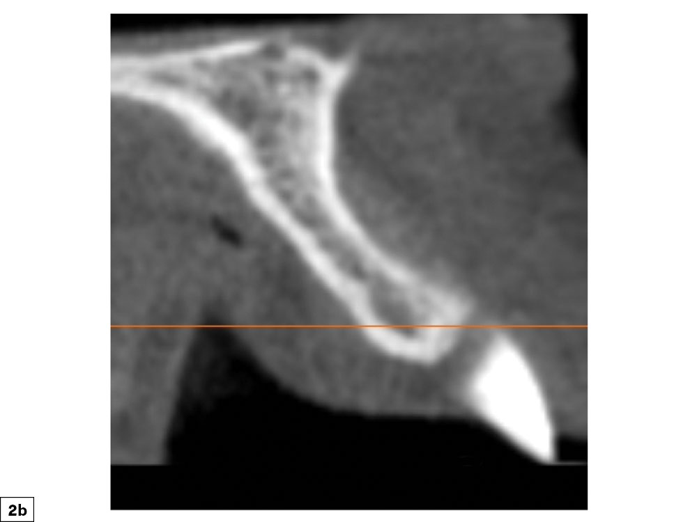 Guided Bone Regeneration: 8 Augmentation Steps | Glidewell