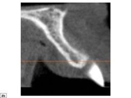 Guided Bone Regeneration: 8 Augmentation Steps | Glidewell