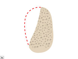 Guided Bone Regeneration: 8 Augmentation Steps | Glidewell