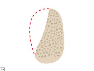 Guided Bone Regeneration: 8 Augmentation Steps | Glidewell