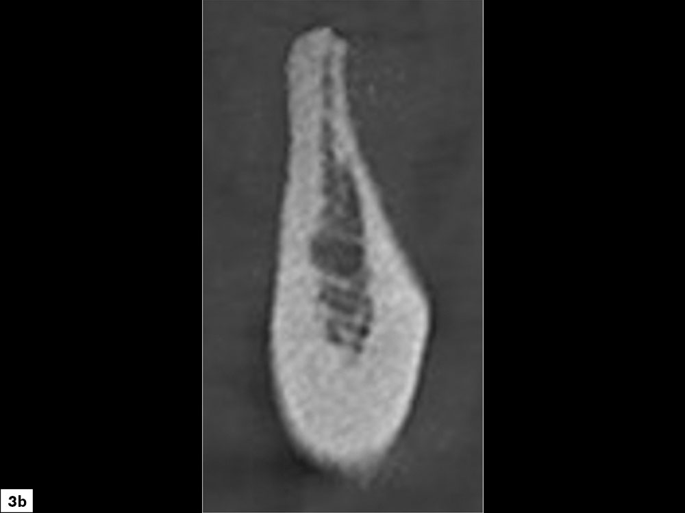 Guided Bone Regeneration: 8 Augmentation Steps | Glidewell