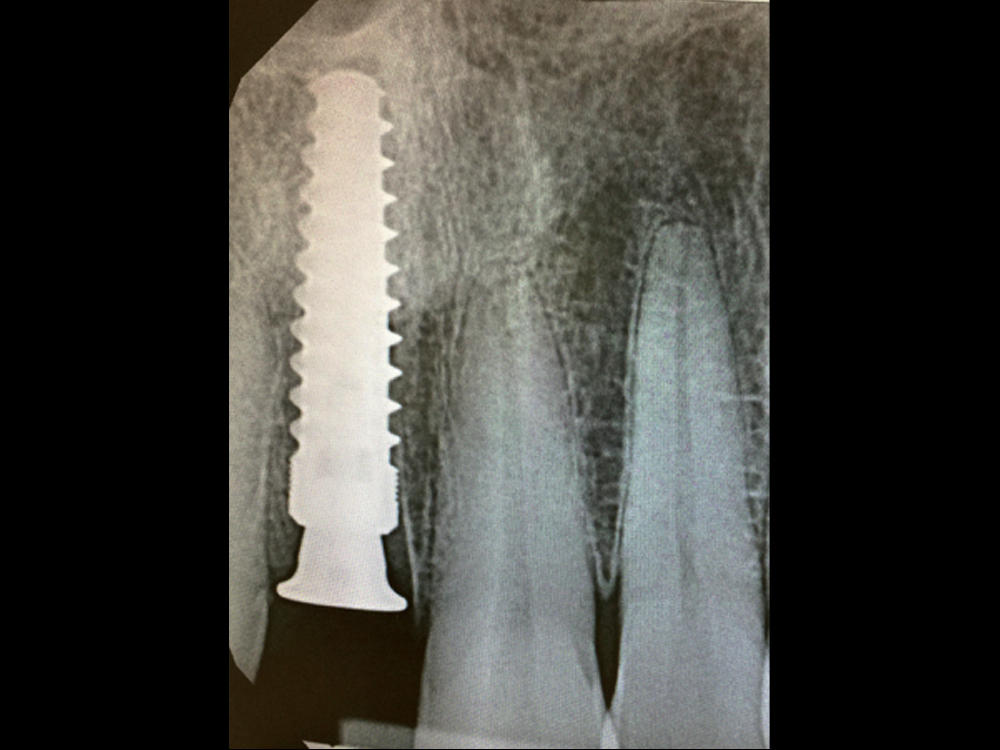 Types Of Implants Tapered Vs Parallel Walled Glidewell