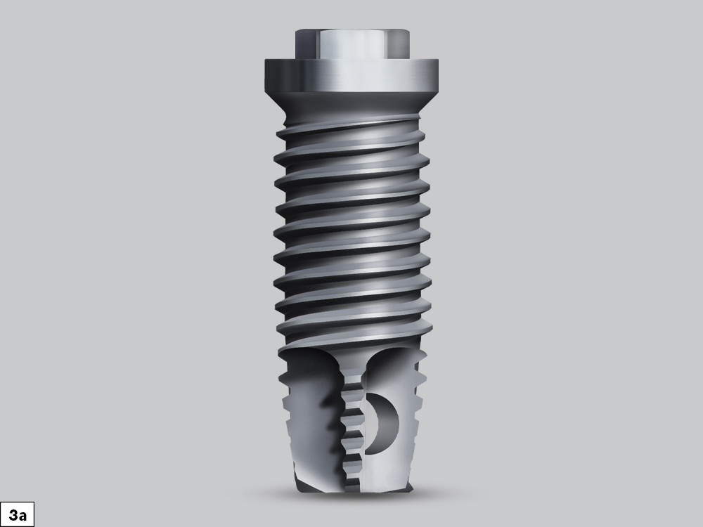 Types of Implants: Tapered vs. Parallel-Walled | Glidewell