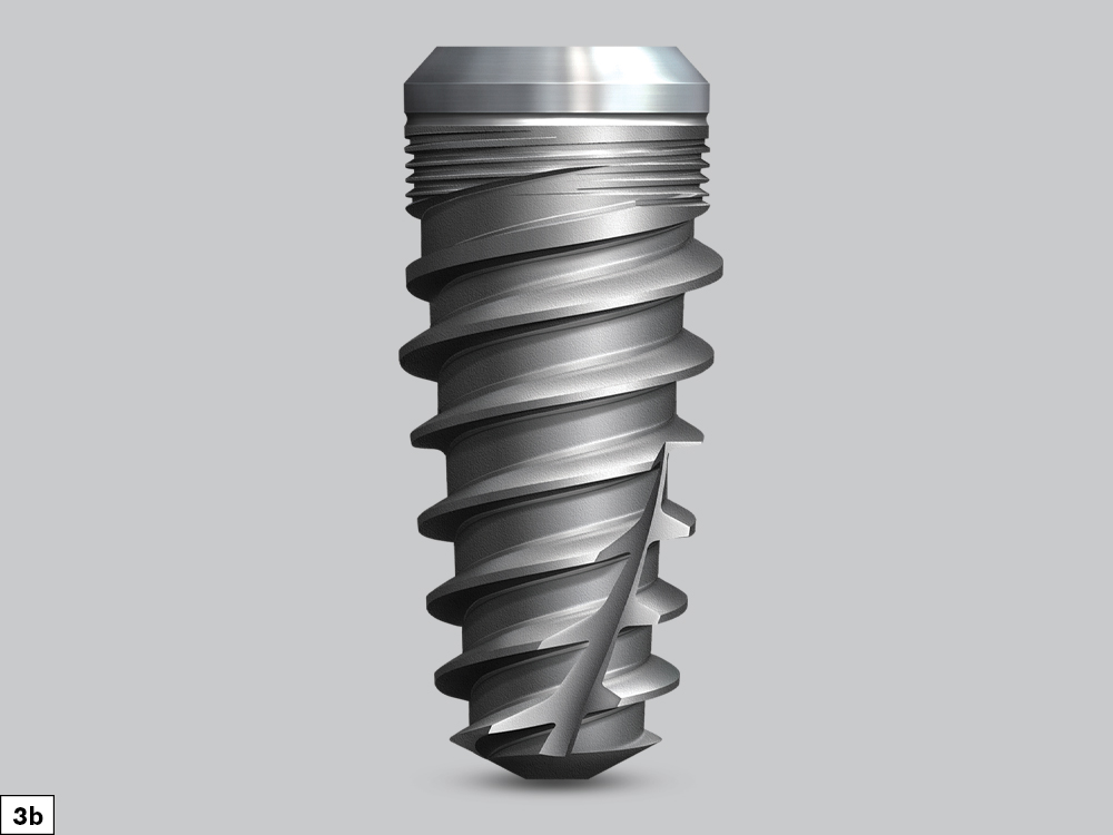 Types of Implants: Tapered vs. Parallel-Walled | Glidewell