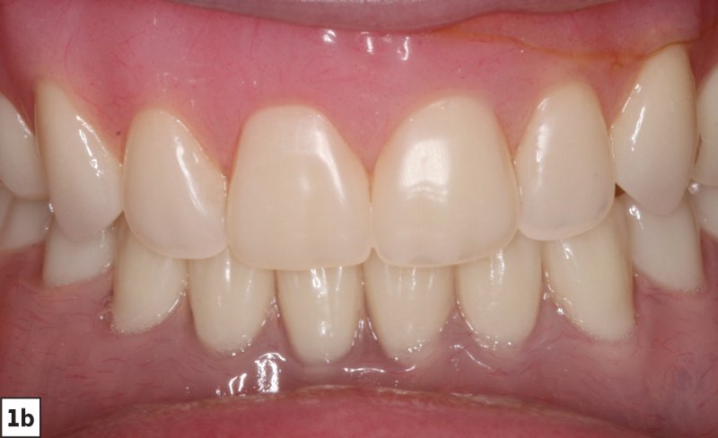 Implant Overdentures: The Right Treatment | Glidewell