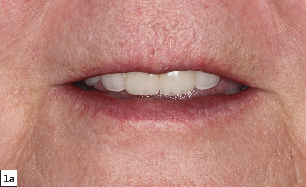 Implant Overdentures: The Right Treatment | Glidewell
