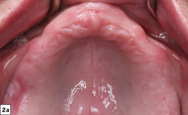 Implant Overdentures: The Right Treatment | Glidewell