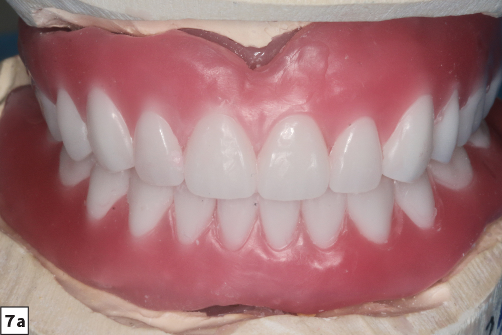 Implant Overdentures: The Right Treatment | Glidewell