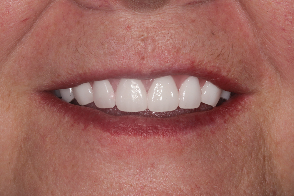 Implant Overdentures: The Right Treatment | Glidewell