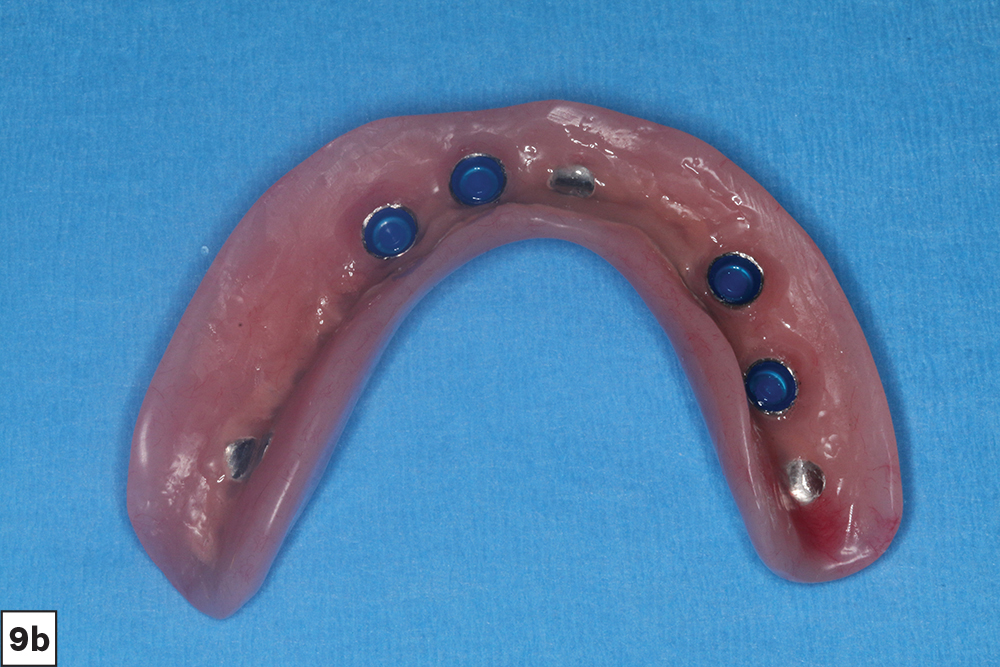 Implant Overdentures: The Right Treatment | Glidewell