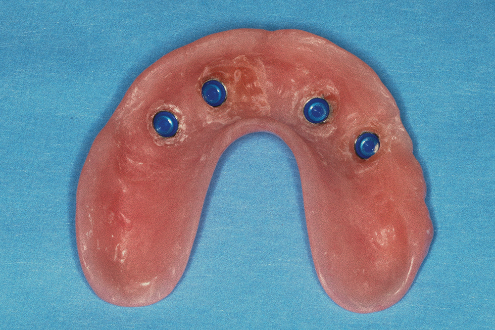 Implant Overdentures: The Right Treatment | Glidewell