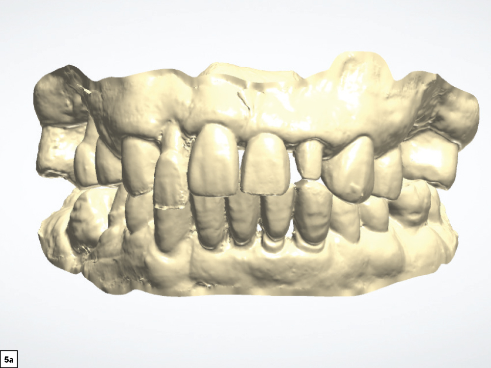 Immediate Dentures: 3D Printed Dentures Case Report