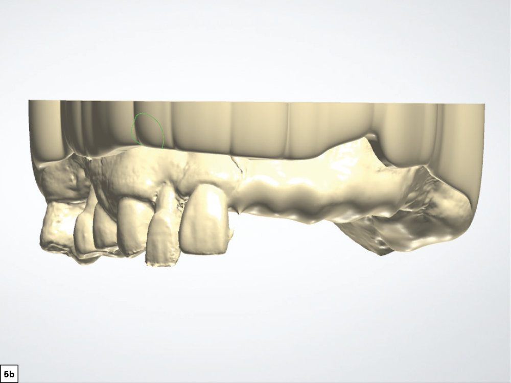 Immediate Dentures: 3D Printed Dentures Case Report