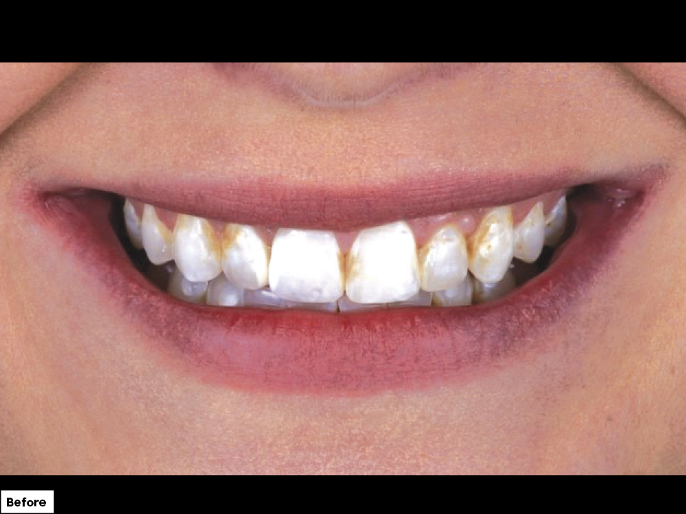 BruxZir Esthetic Zirconia for Crowns and Veneers