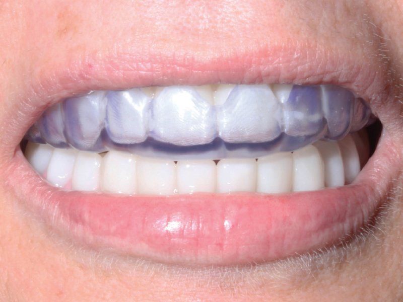 Occlusal Splint Product Spotlight: Comfort3D Bite Splint