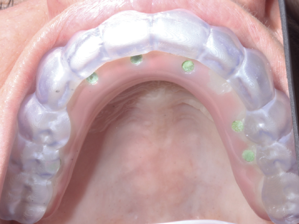 Occlusal Splint Product Spotlight: Comfort3D Bite Splint