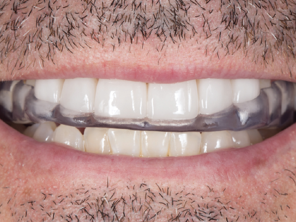 Occlusal Splint Product Spotlight: Comfort3D Bite Splint