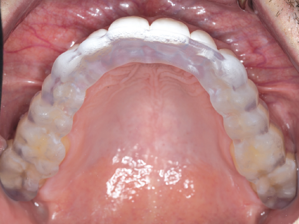 Occlusal Splint Product Spotlight: Comfort3D Bite Splint