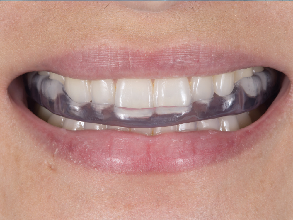 Occlusal Splint Product Spotlight: Comfort3D Bite Splint